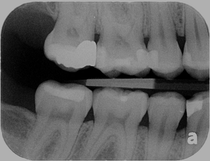 Mercury Filling Decay & Corrosion : Aurora Dentist | Holistic Dentist ...